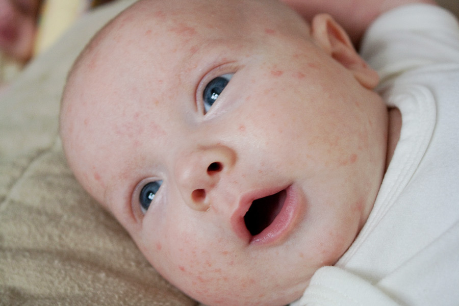 Baby Acne - Newborn Baby Ko Pimples (Acne) Kyo Hote Hain